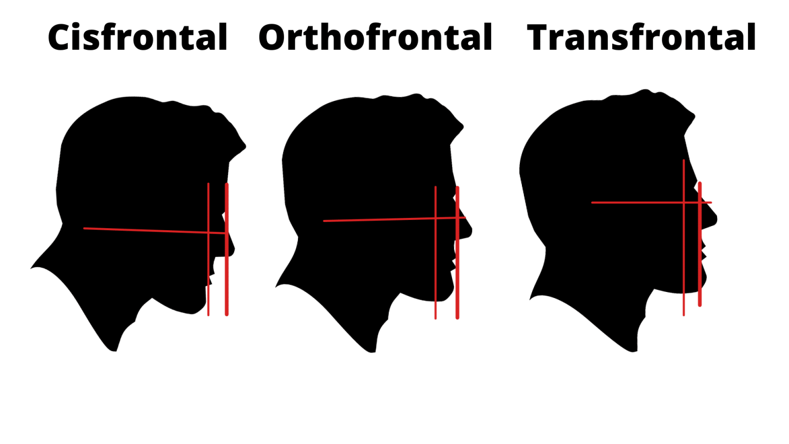 Voies aérodigestives supérieures dans le SAOS - DORCONFORT